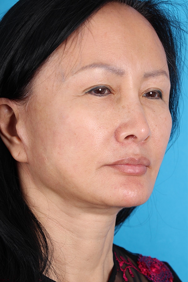 Facelift - VIP Plastic Surgery