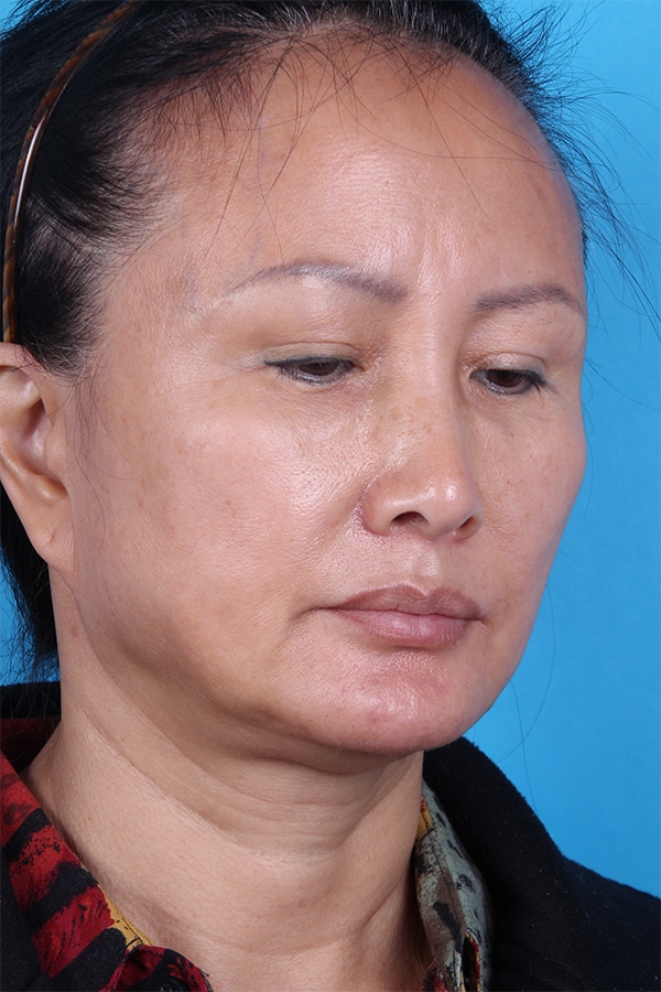 Facelift - VIP Plastic Surgery