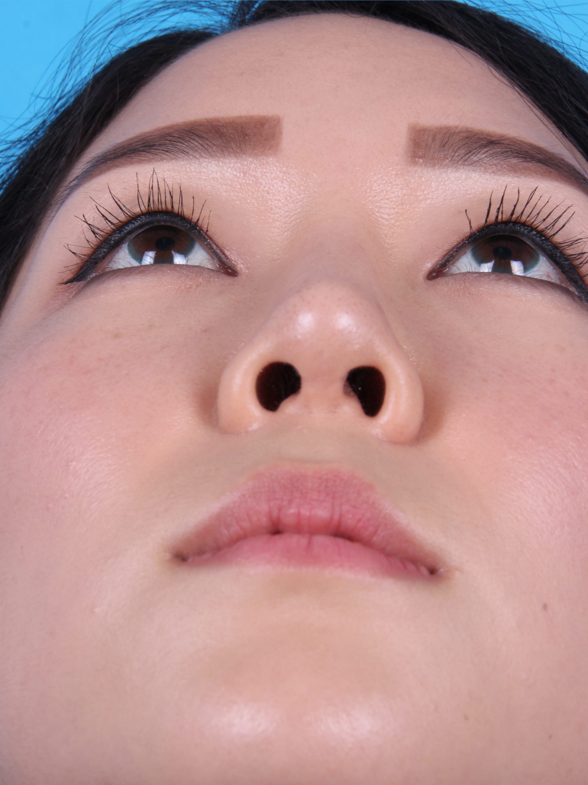 Rhinoplasty - VIP Plastic Surgery