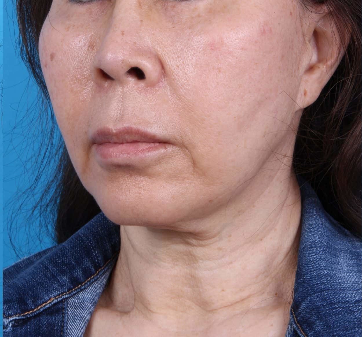Facelift Archives - VIP Plastic Surgery