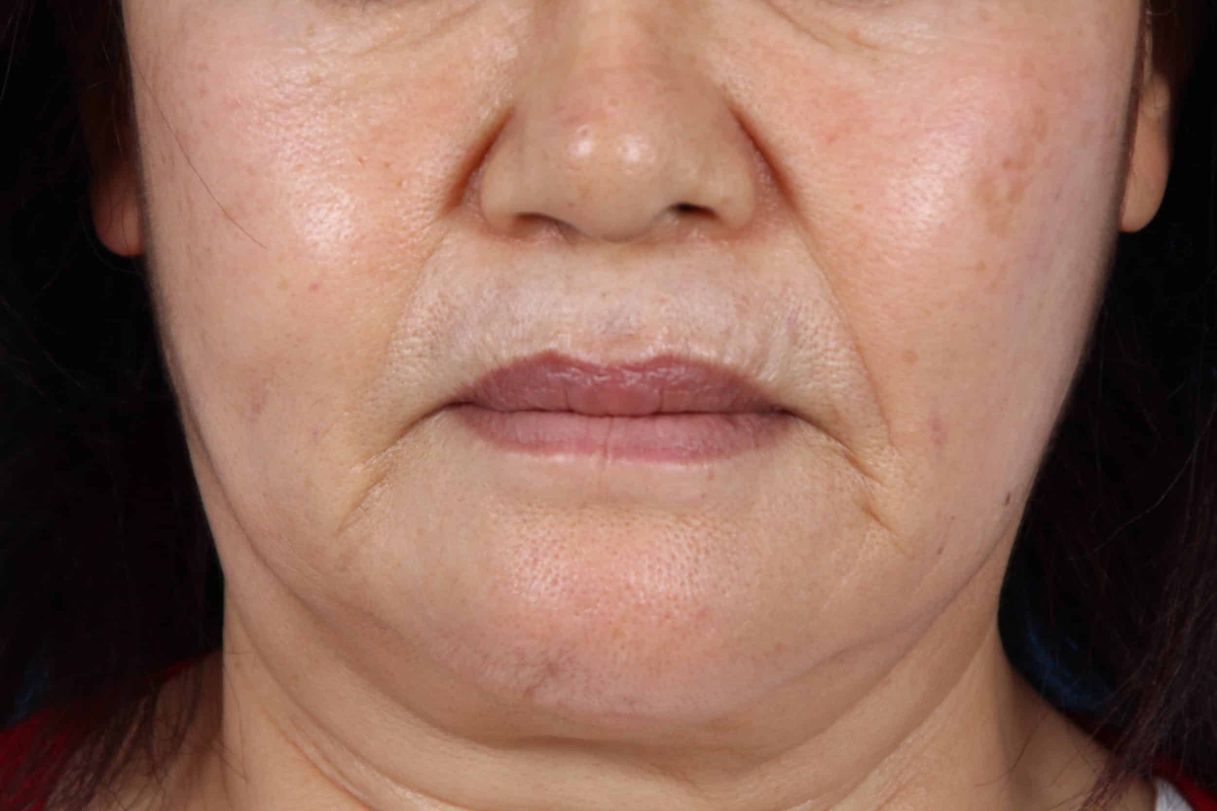 Radiesse on Smile Lines - VIP Plastic Surgery