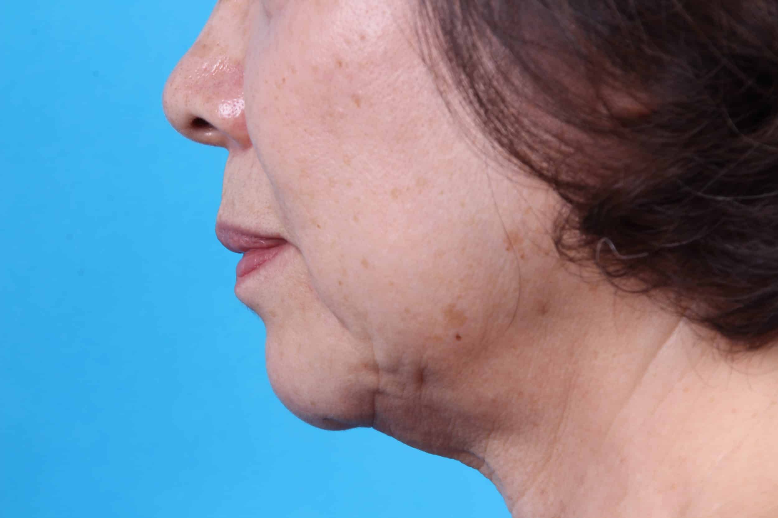 Versa - VIP Plastic Surgery