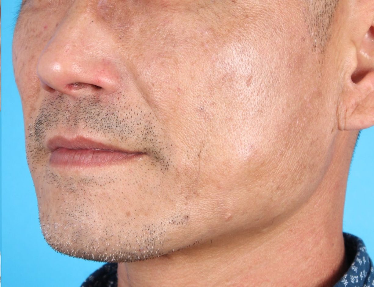 IPL - VIP Plastic Surgery