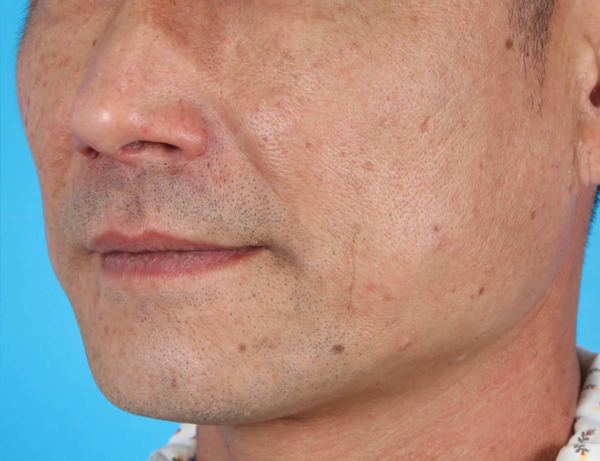 IPL - VIP Plastic Surgery