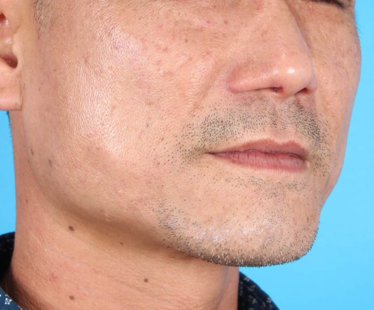 IPL - VIP Plastic Surgery