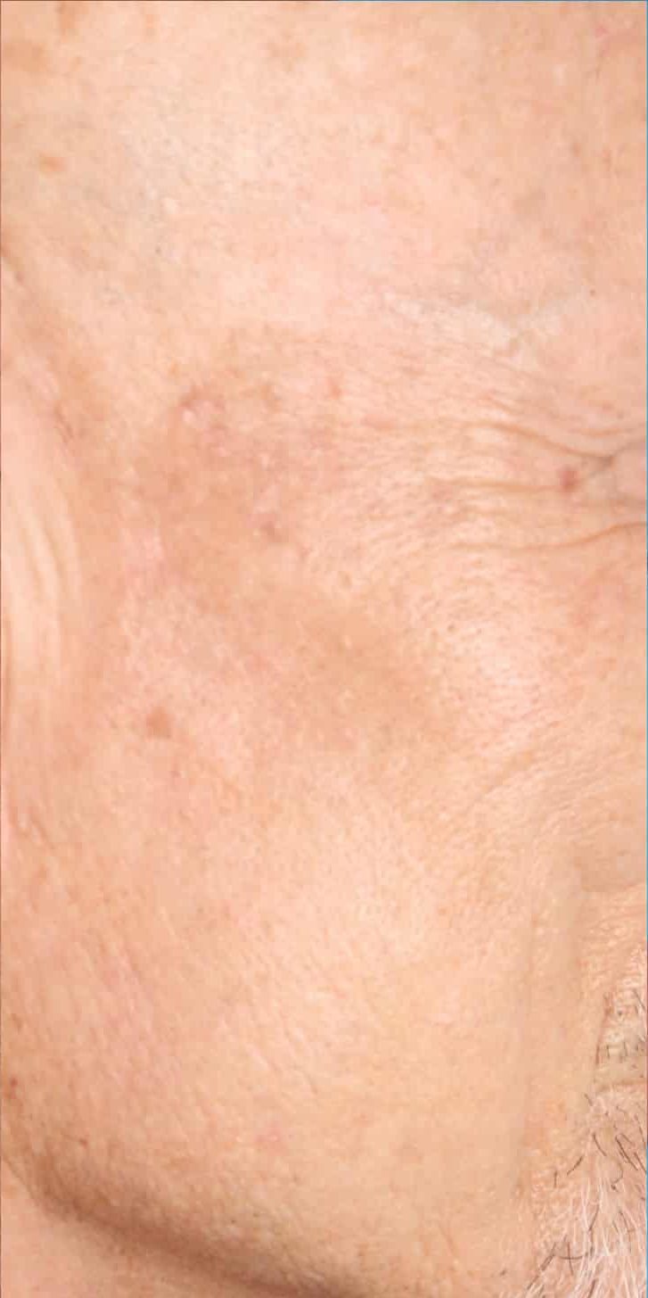 IPL - VIP Plastic Surgery