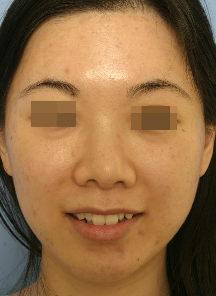 Belotero - VIP Plastic Surgery