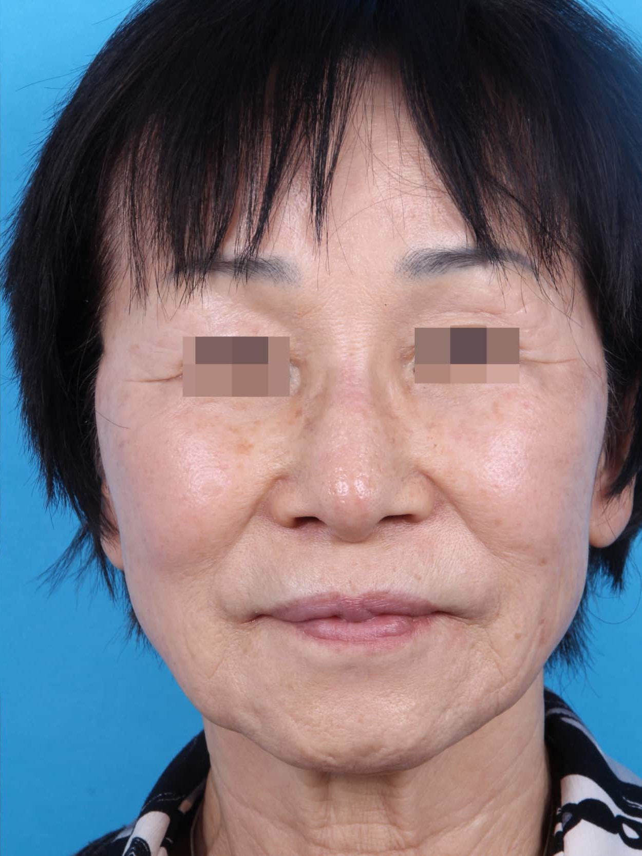 Belotero - VIP Plastic Surgery