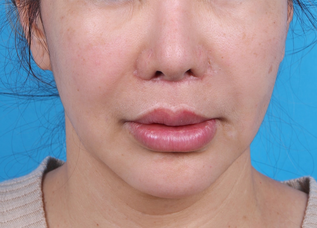 Lip Lift Archives - VIP Plastic Surgery