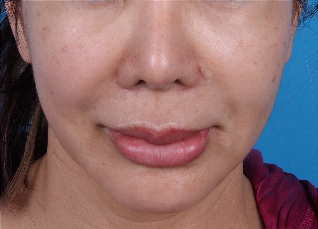 Lip Lift Archives - VIP Plastic Surgery