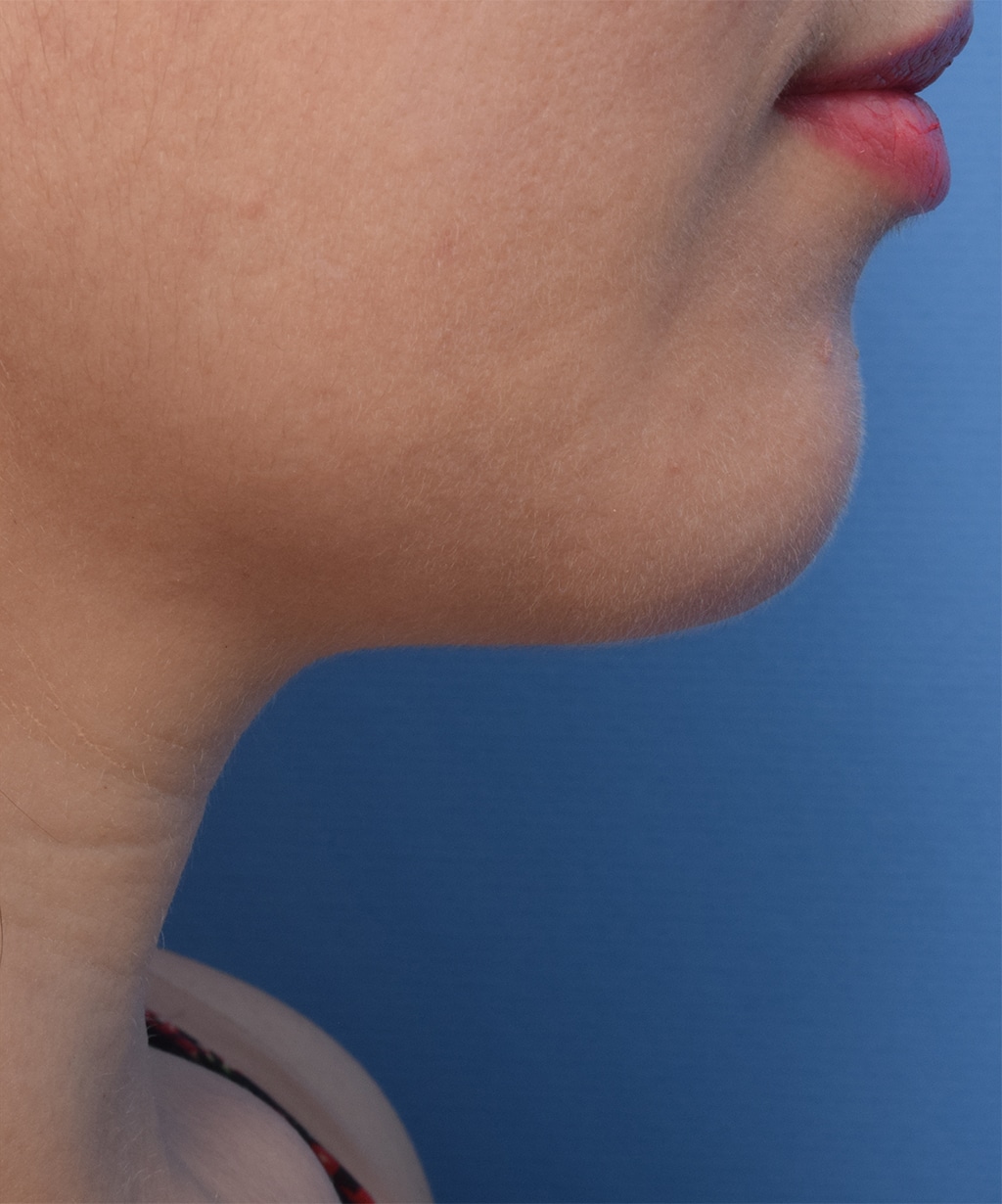 Neck Liposuction Archives - VIP Plastic Surgery