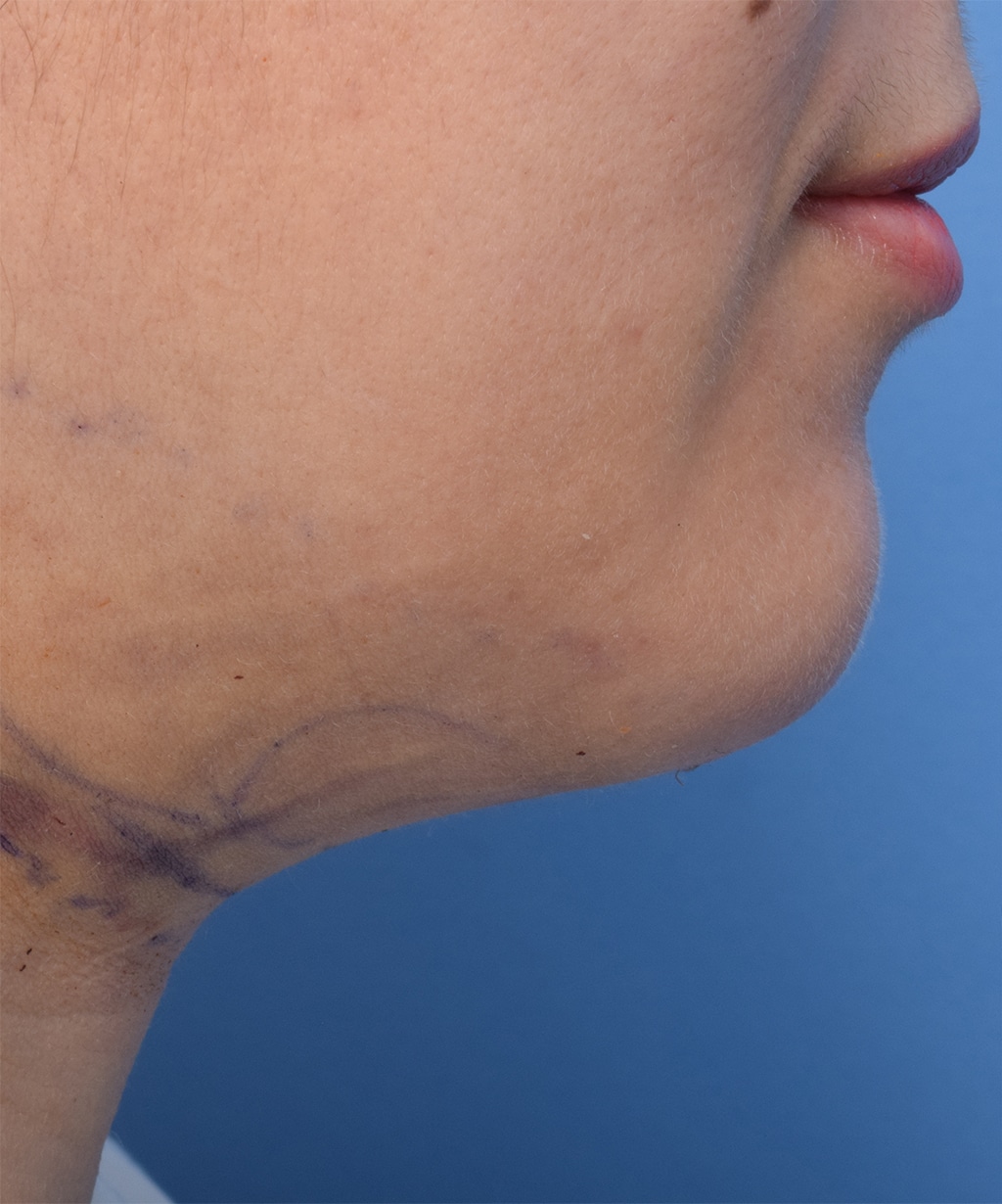 Neck Liposuction Archives - VIP Plastic Surgery