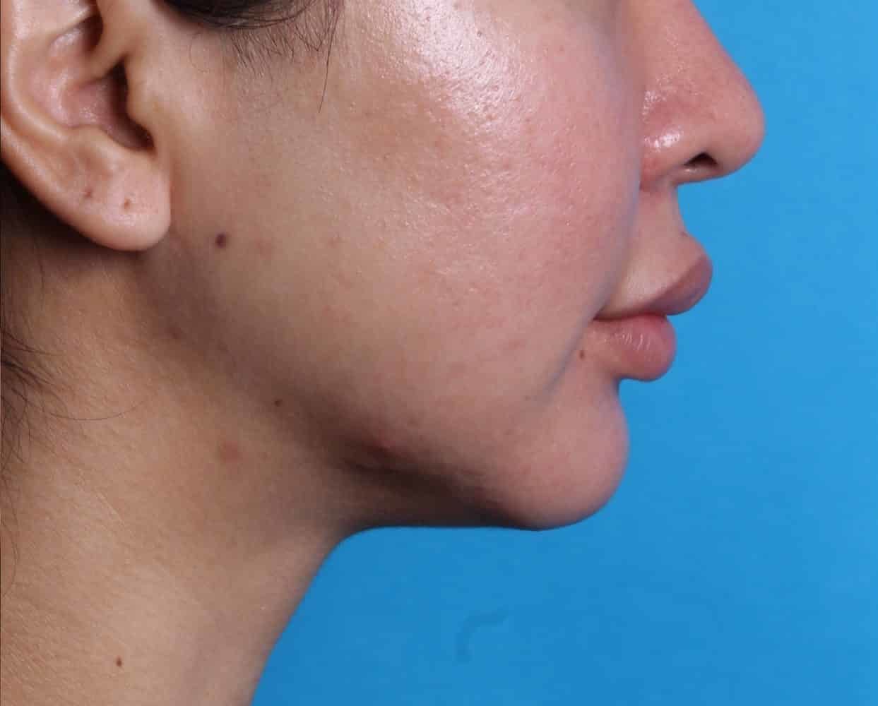 Neck Liposuction Archives - VIP Plastic Surgery