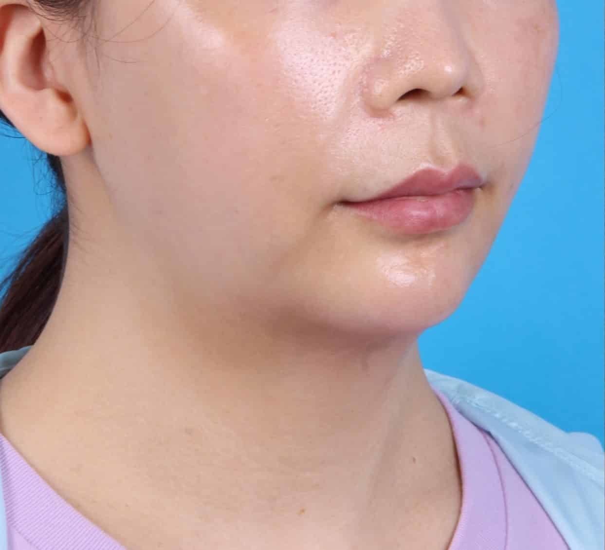 Neck Liposuction Archives - VIP Plastic Surgery