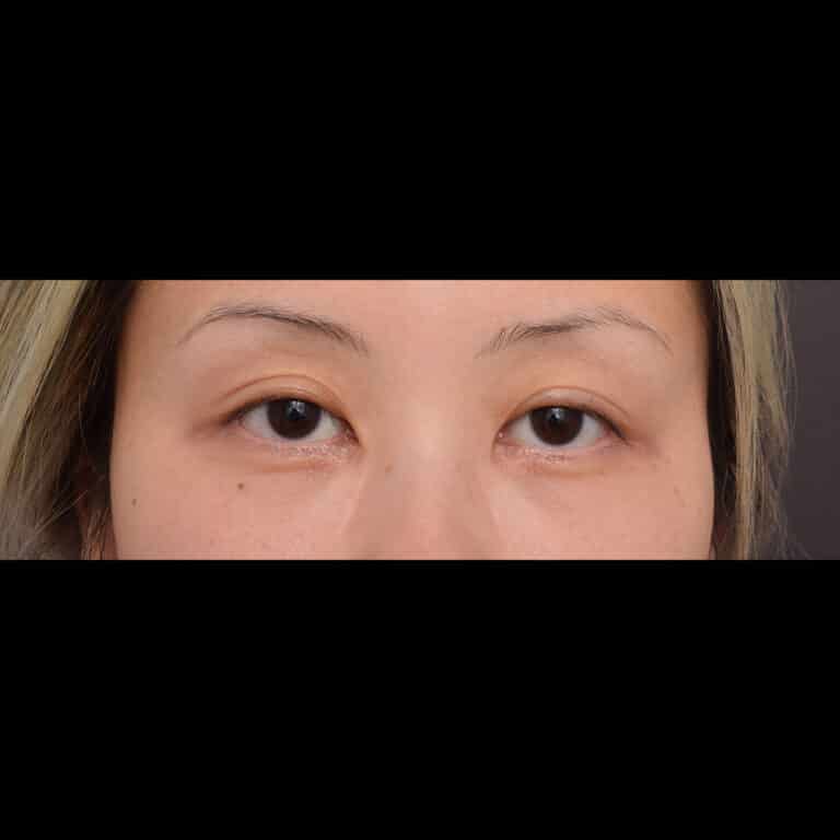 Epicanthoplasty - VIP Plastic Surgery