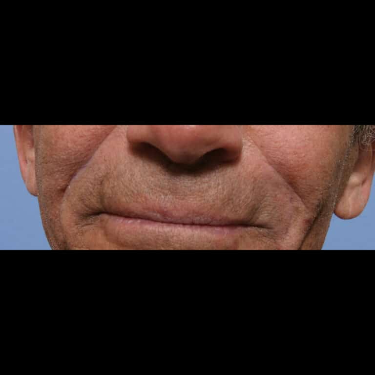 Filler on smile lines - VIP Plastic Surgery