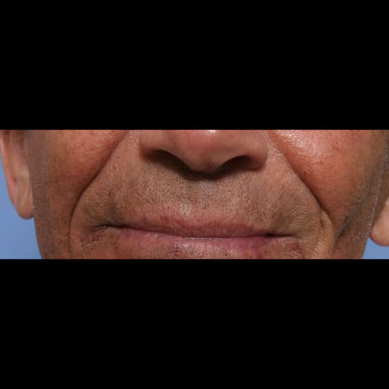 Filler on smile lines - VIP Plastic Surgery